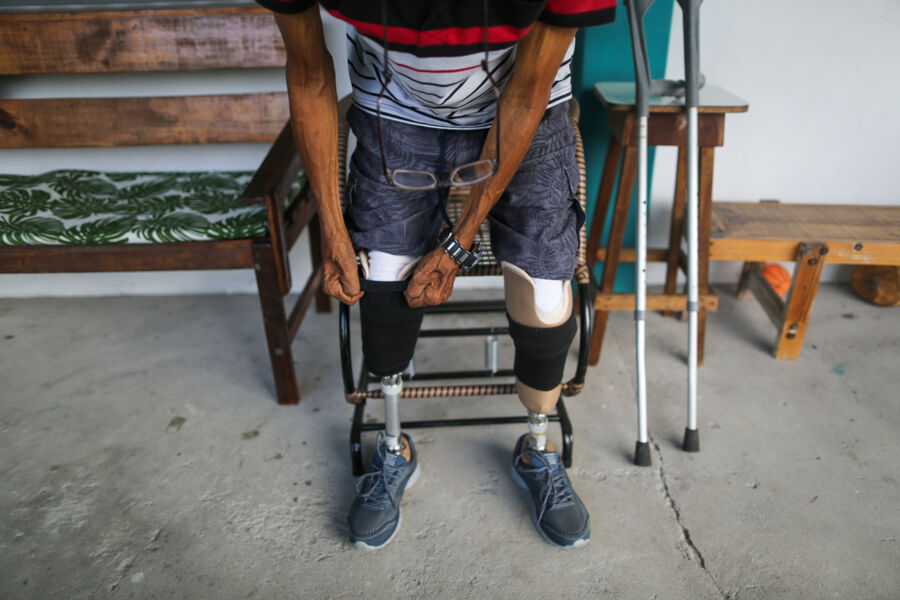 Bahia é campeão nordestino em amputações de membros inferiores